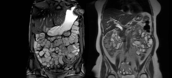 MRI Enterography | I-MED Radiology Network