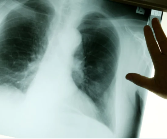 Dust disease in the news | I-MED Radiology Network