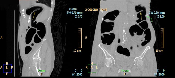 CT Colonography | I-MED Radiology Network