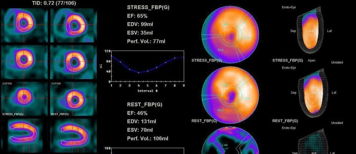 Myocardial perfusion scan | I-MED Radiology Network