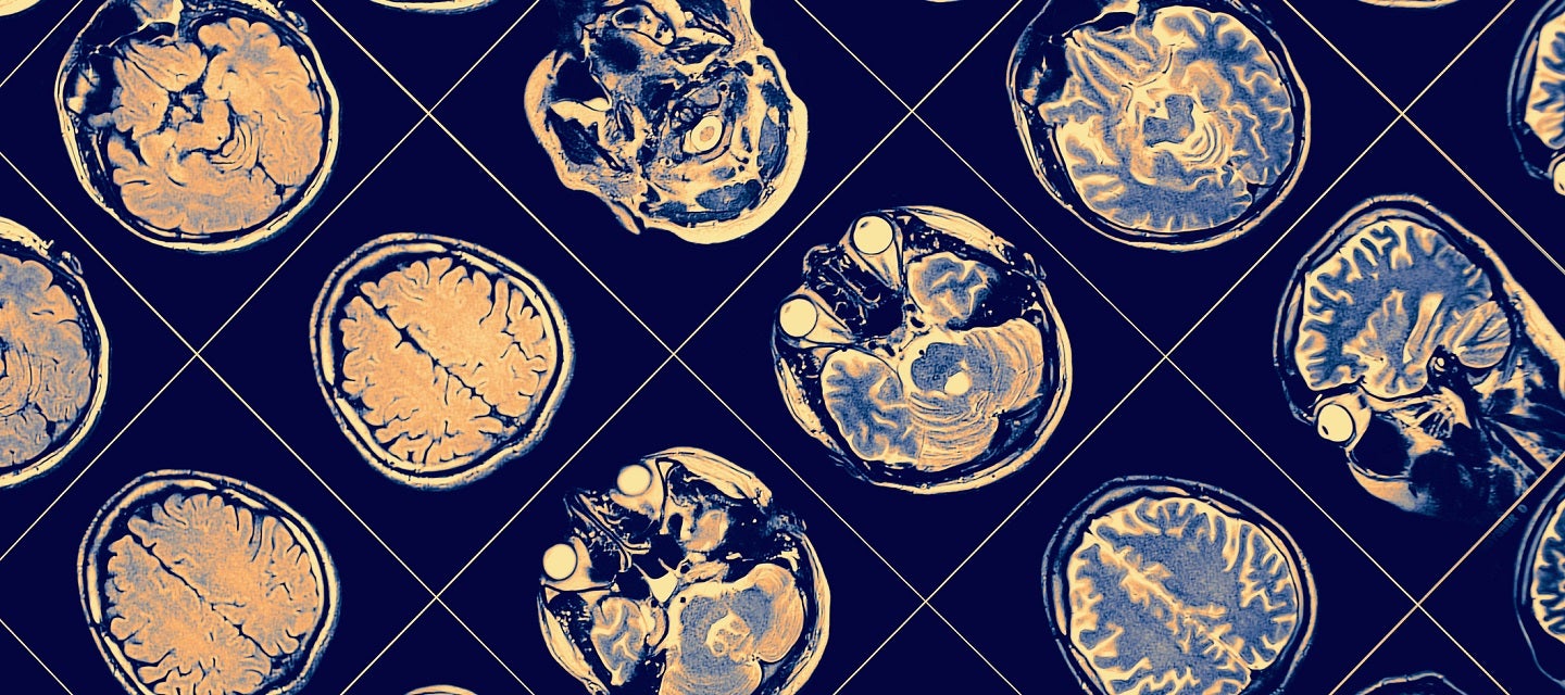 Brain imaging (neuroimaging) | I-MED Radiology Network