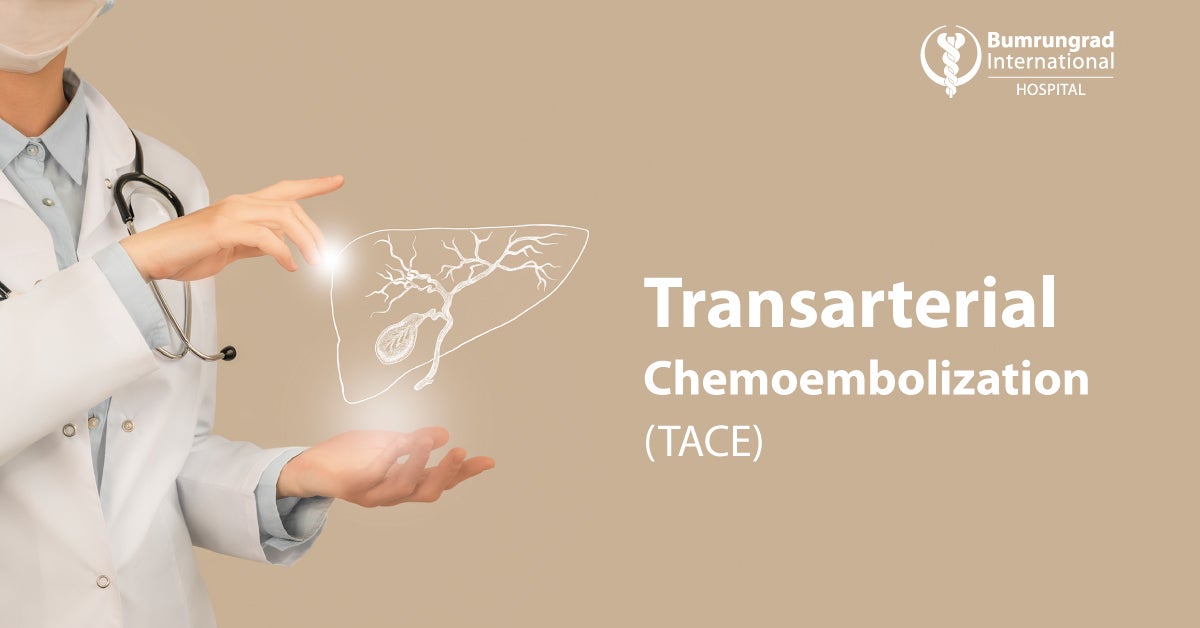 Transarterial chemoembolization (TACE)