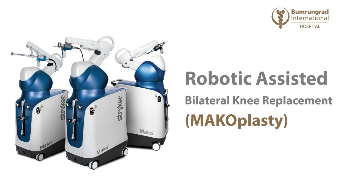 Bilateral Total Knee Replacement Surgery by MAKO Robotic