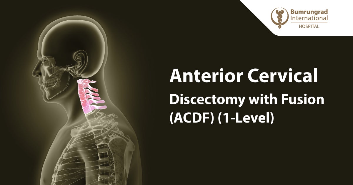 Anterior Cervical Discectomy with Fusion 1 Level (ACDF)