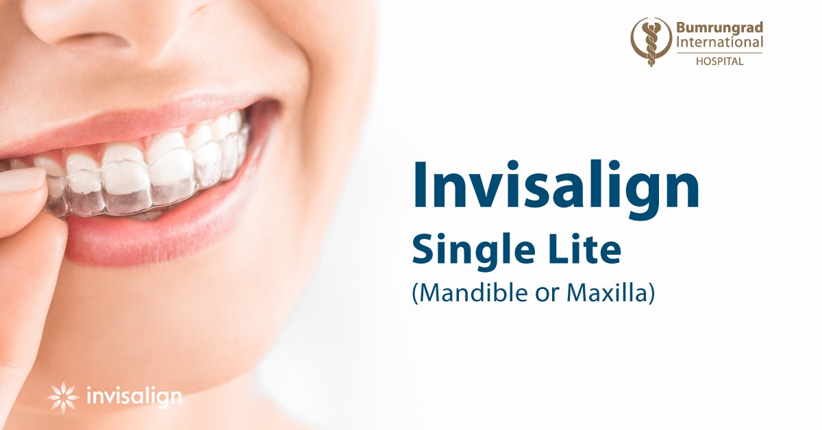 Invisalign Single Lite (Mandible or Maxilla)