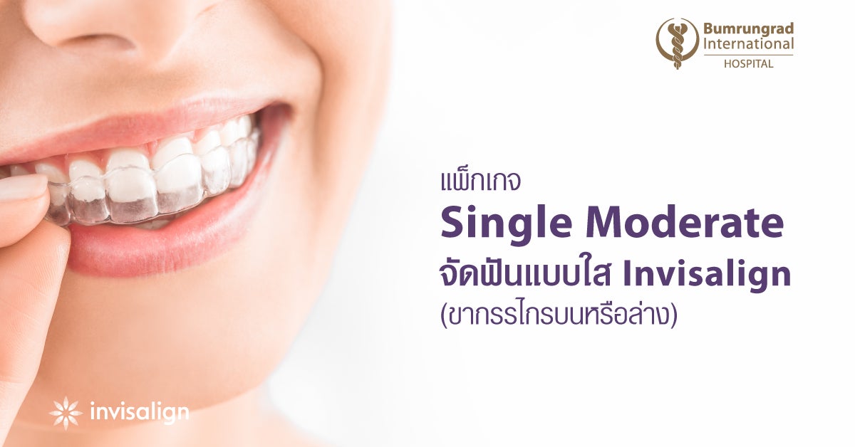 แพ็กเกจ Single Moderate จัดฟันแบบใส Invisalign (ขากรรไกรบนหรือล่าง)