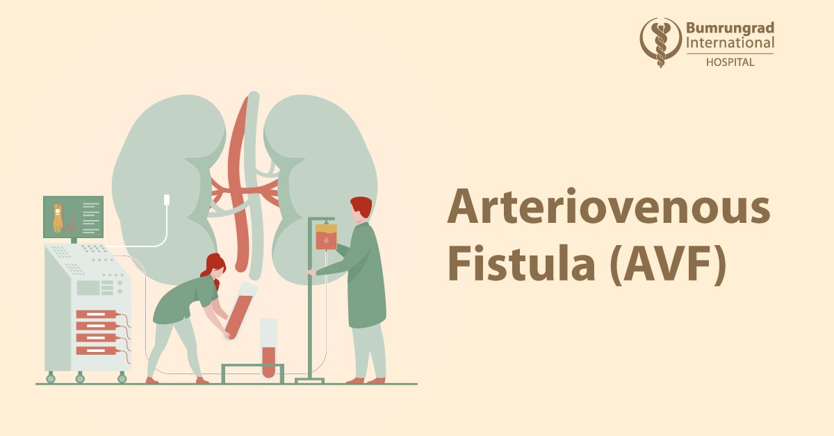 Arteriovenous fistula (AVF)