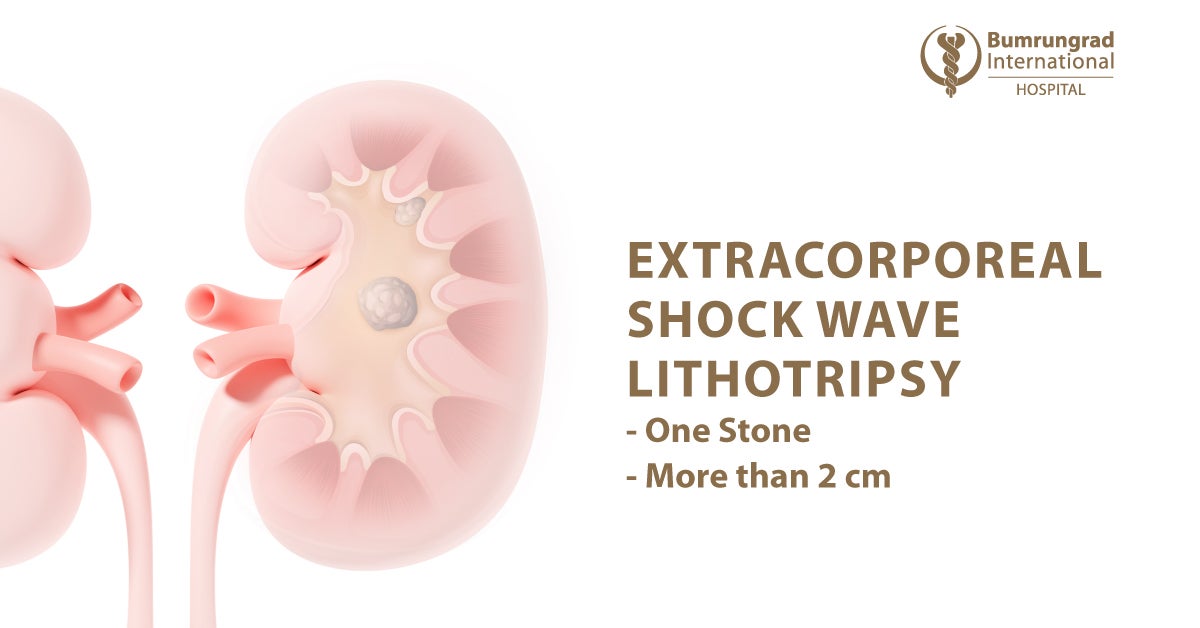 Extracorporeal Shock Wave Lithotripsy (One Stone, More than 2cm.)