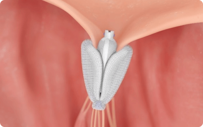 What is transcatheter edge-to-edge repair (TEER) | Edwards Lifesciences