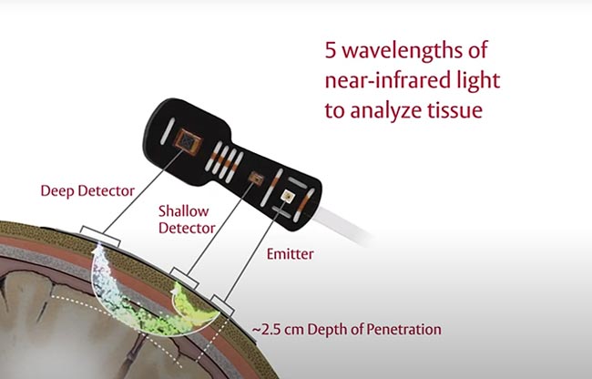 ForeSight tissue oximetry sensor | Edwards Lifesciences