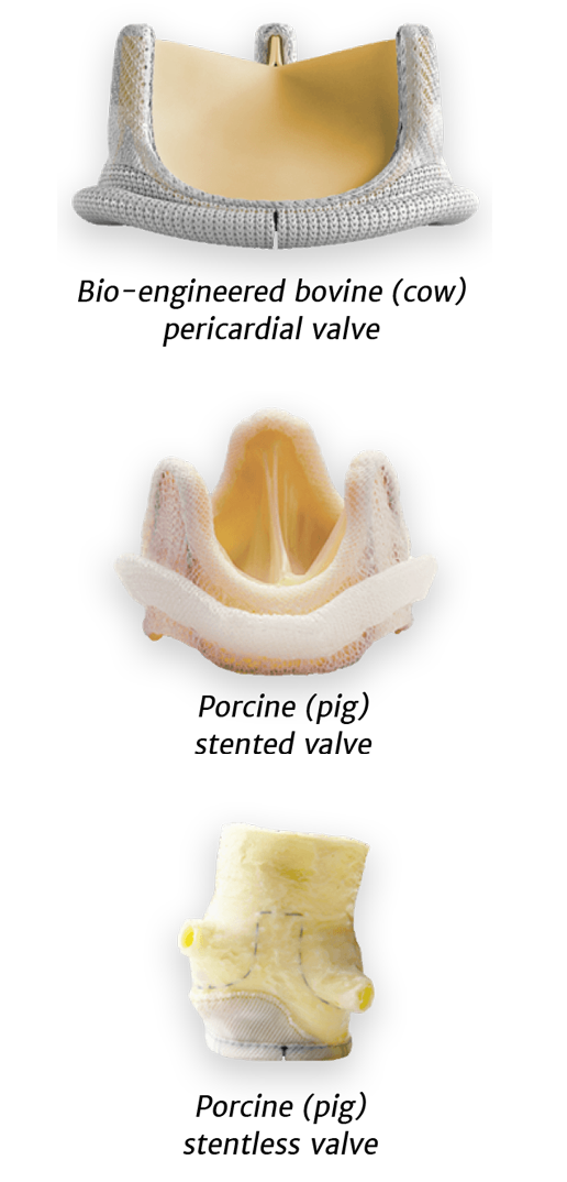 Sustitución y reparación quirúrgica de válvulas | Edwards Lifesciences