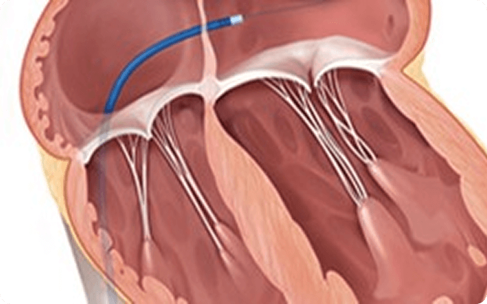 What is transcatheter edge-to-edge repair (TEER) | Edwards Lifesciences