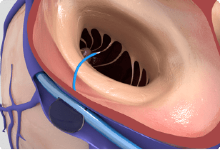 ALT-FLOW trial | Edwards Lifesciences