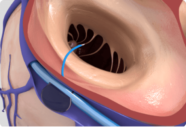 ALT-FLOW trial | Edwards Lifesciences