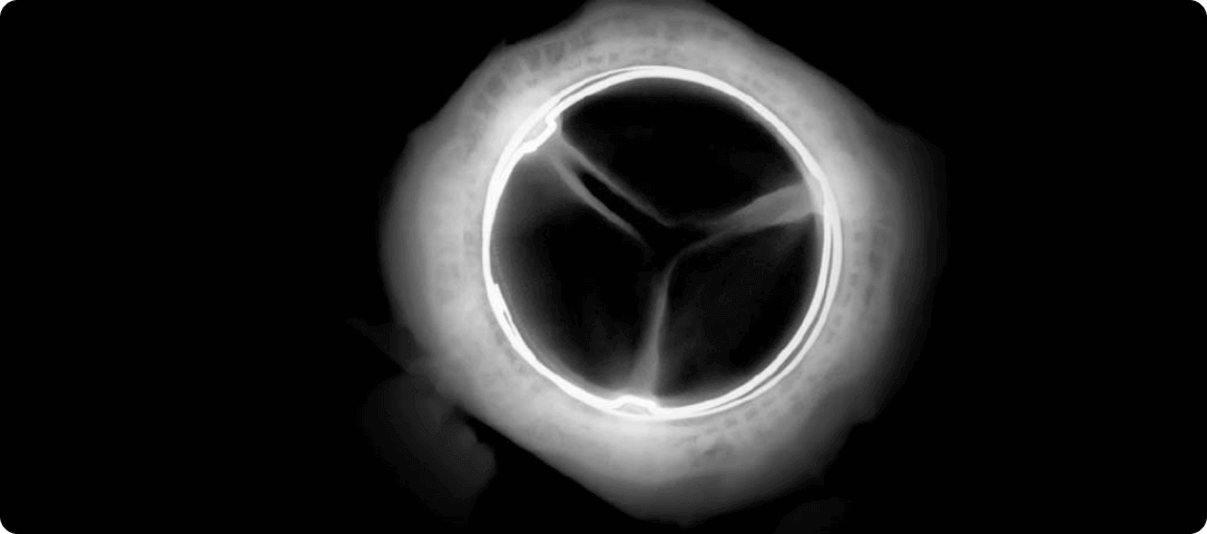 Transcatheter SAPIEN 3 Ultra RESILIA | Edwards Lifesciences