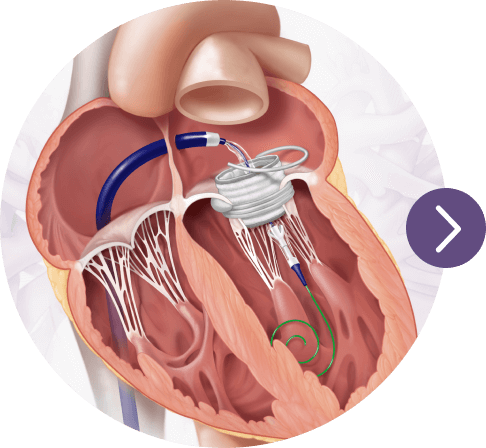 Sapien M3 | Edwards Lifesciences