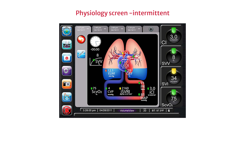 VolumeView System | Edwards Lifesciences