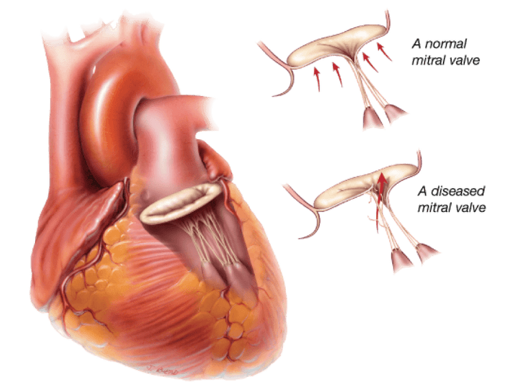Valve Defects | Edwards Lifesciences