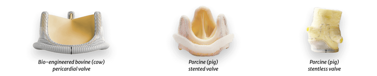 Surgical valve repair & replacement | Edwards Lifesciences