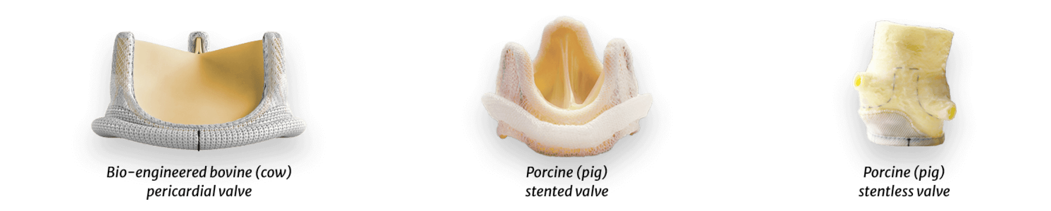 Surgical valve replacement | Edwards Lifesciences