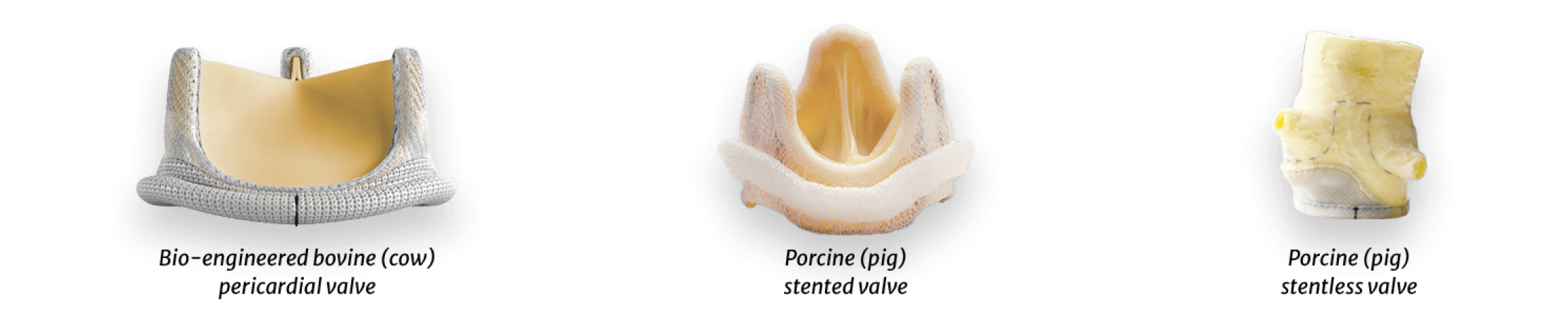 Surgical valve replacement | Edwards Lifesciences