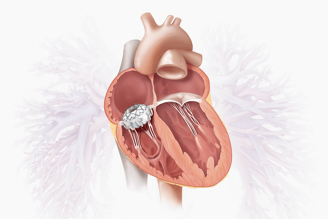 Severe tricuspid valve regurgitation and treatment | Edwards Lifesciences