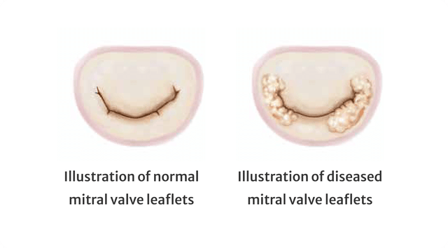 RESILIA mitral valve | Edwards Lifesciences