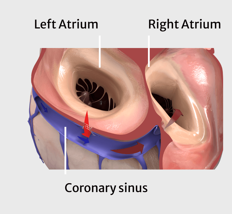 ALT-FLOW II Trial | Edwards Lifesciences