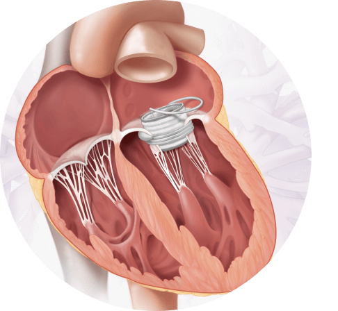 Sapien M3 | Edwards Lifesciences