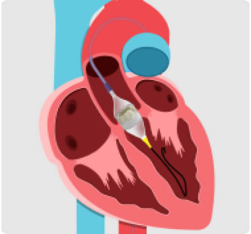 Before and during aortic valve replacement procedure | newheartvalve.asia