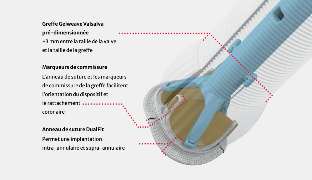 Conduit aortique à valve KONECT RESILIA | Edwards Lifesciences