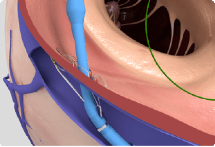 ALT-FLOW trial | Edwards Lifesciences