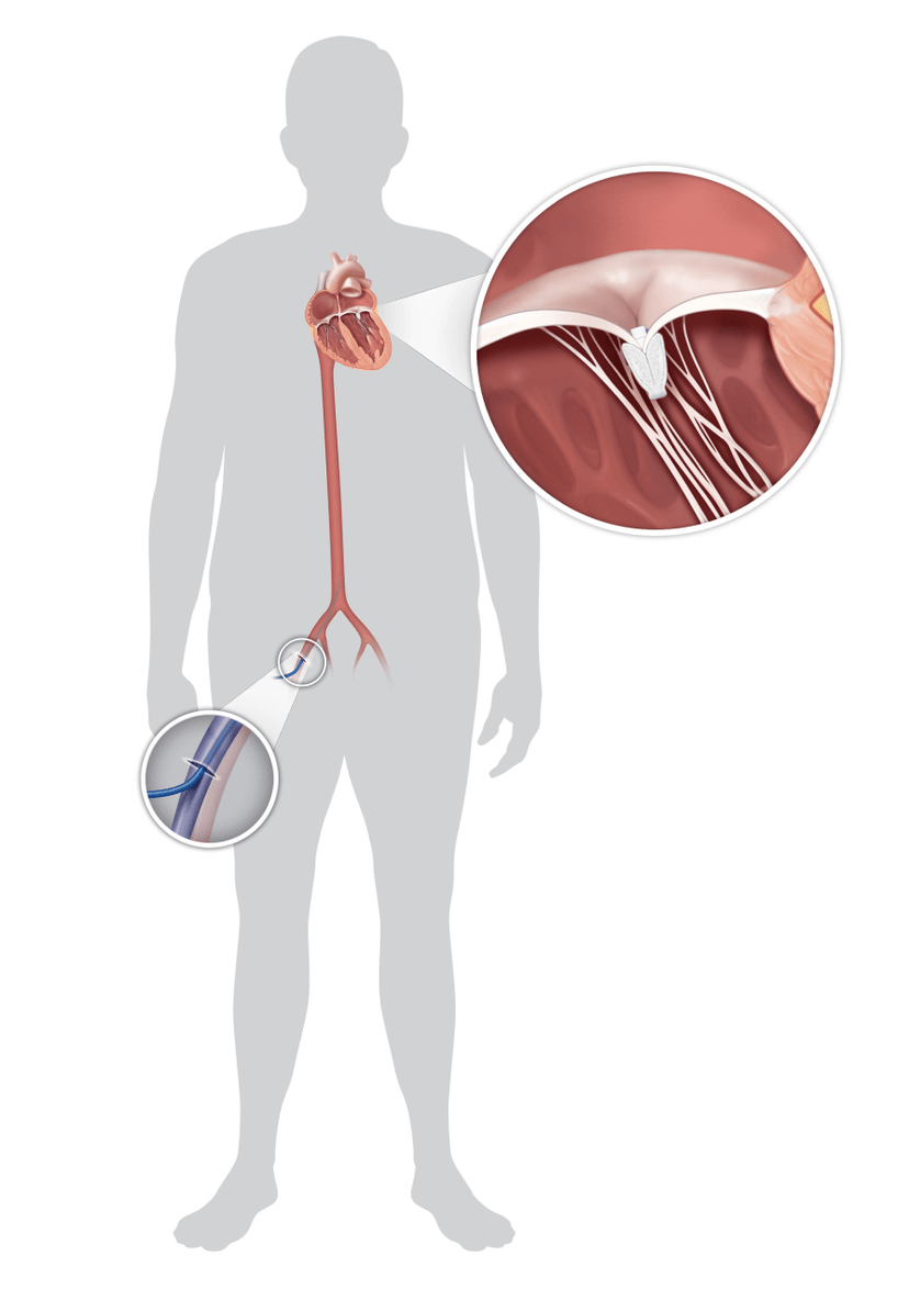 About the PASCAL implant | Edwards Lifesciences