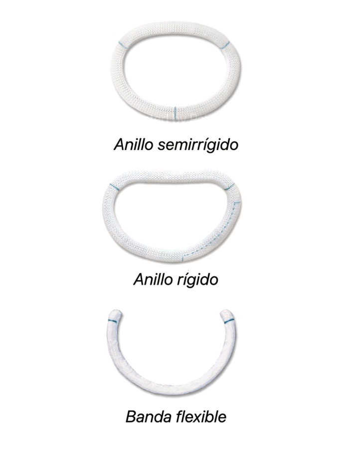 Sustitución y reparación quirúrgica de válvulas | Edwards Lifesciences