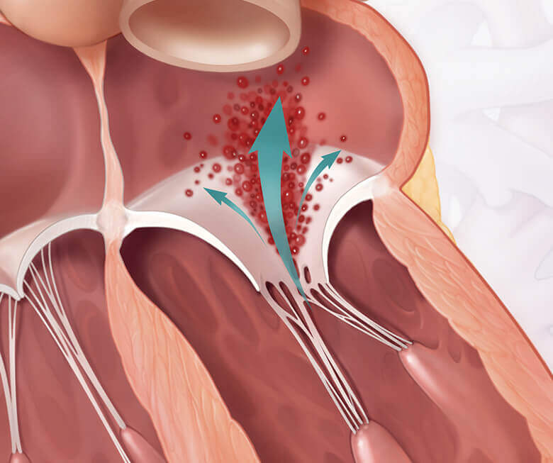 The CLASP IID/IIF Trial for Mitral Regurgitation | Edwards Lifesciences