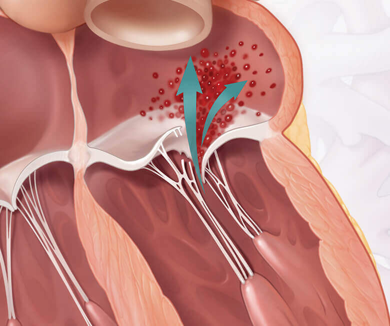 The CLASP IID/IIF Trial for Mitral Regurgitation | Edwards Lifesciences