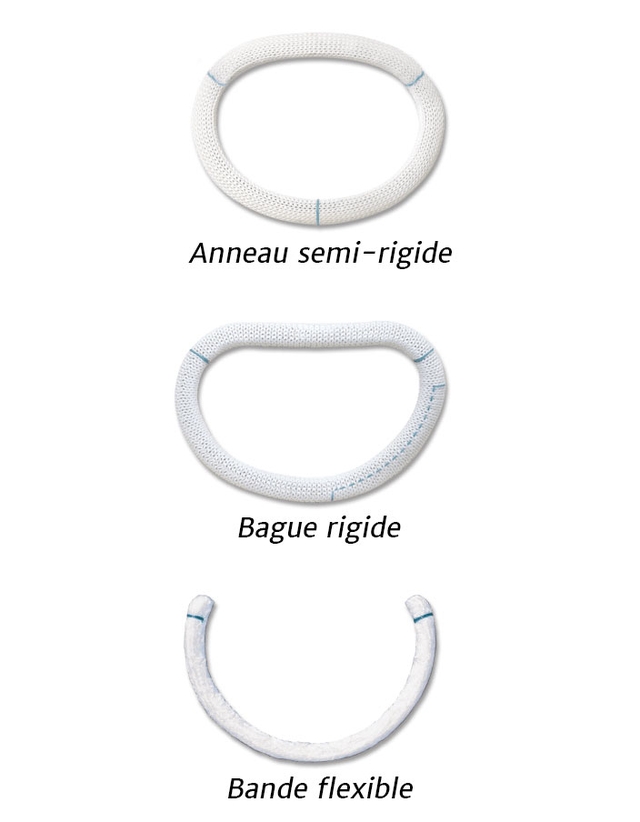 Réparation et remplacement de valves chirurgicales | Edwards Lifesciences
