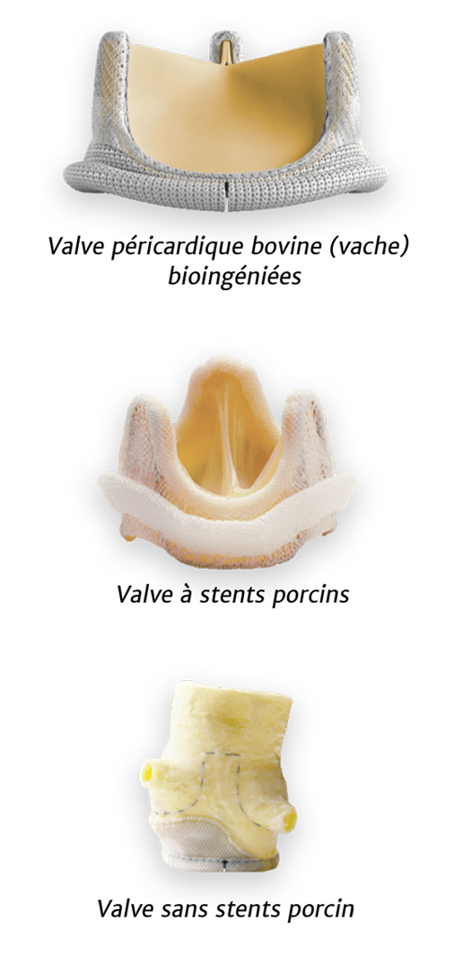 Réparation et remplacement de valves chirurgicales | Edwards Lifesciences