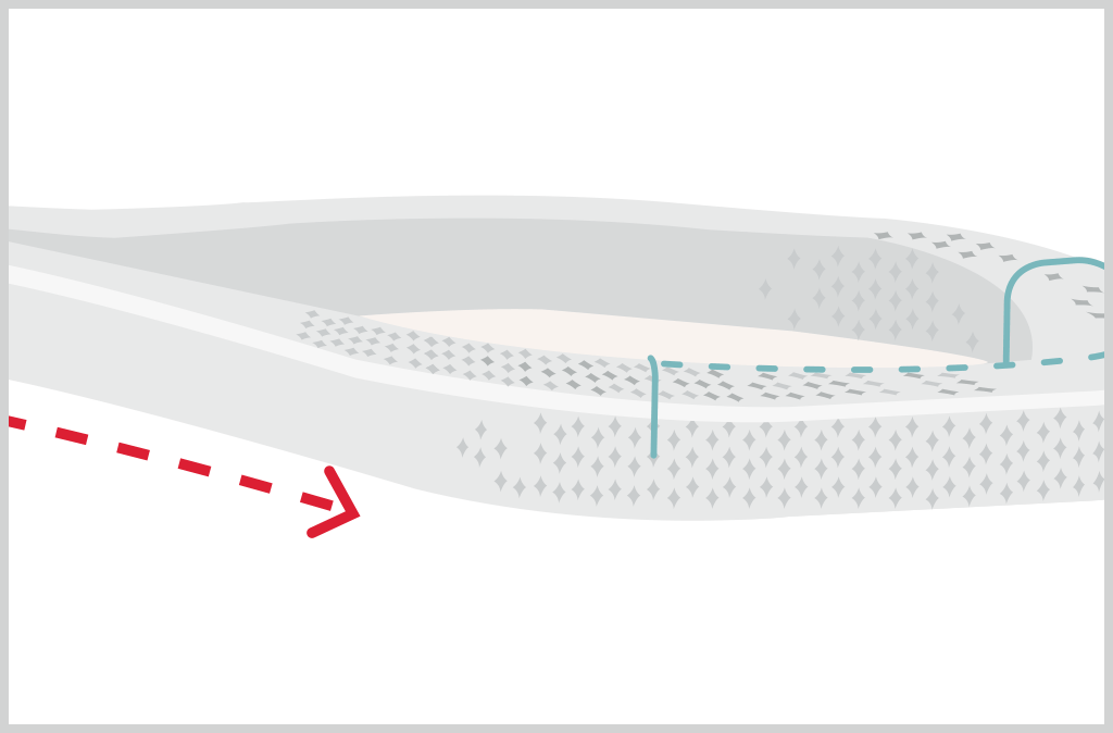 Mitral Valve Repair | Edwards Lifesciences