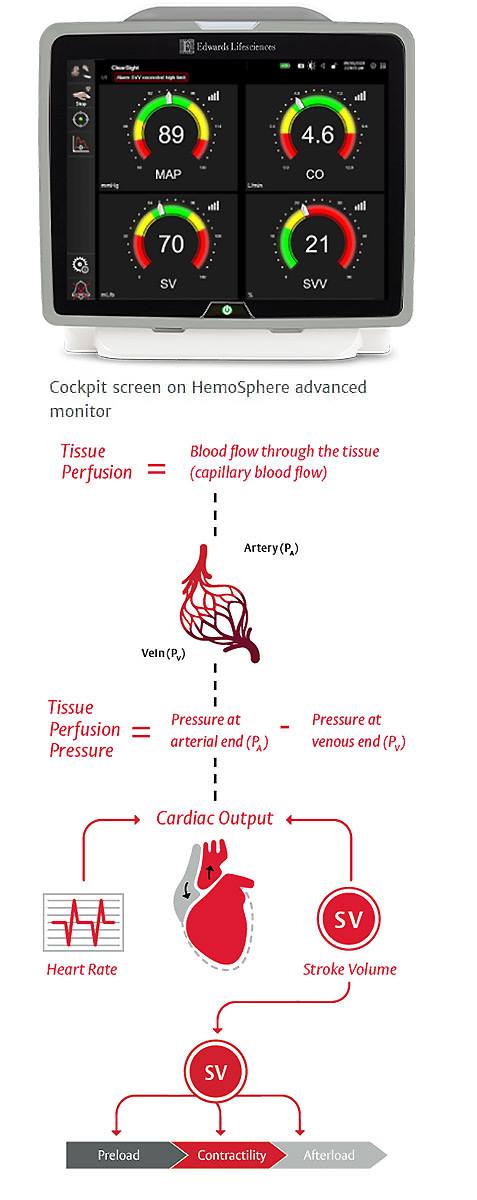 ClearSight system | Edwards Lifesciences