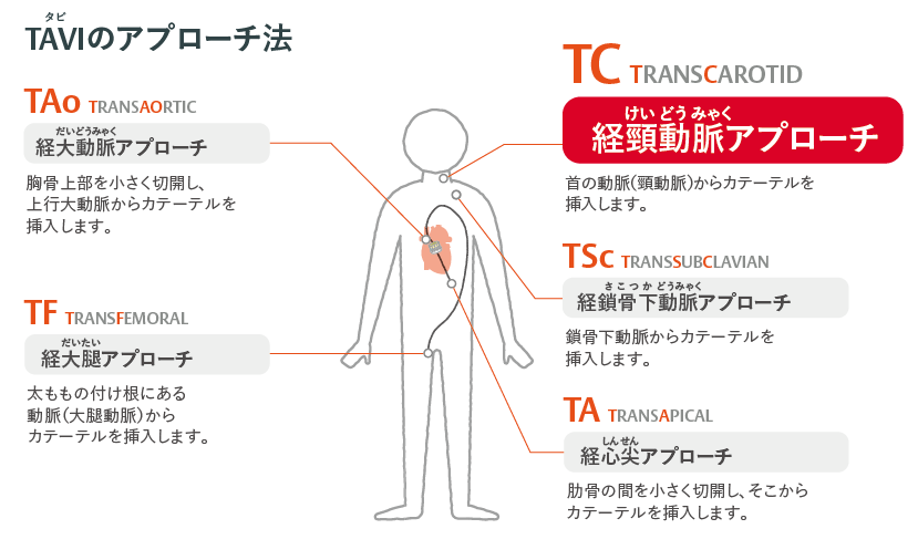 経カテーテル大動脈弁治療（TAVI）用のバルーン拡張型人工心臓弁 本邦における治療オプションがさらに拡大 本邦初の頸動脈アプローチ承認/ 二尖弁に対する有効性と安全性を確認 | Edwards ...