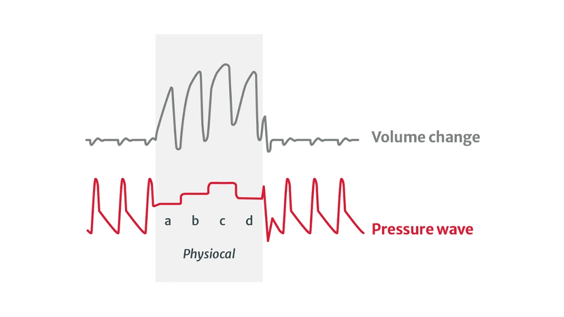 Acumen IQ cuff | Edwards Lifesciences