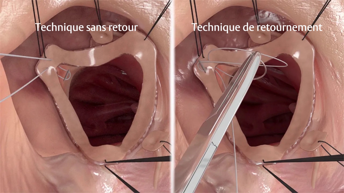 Conduit aortique à valve KONECT RESILIA | Edwards Lifesciences