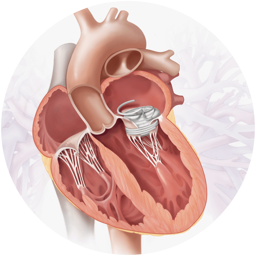 Sapien M3 | Edwards Lifesciences