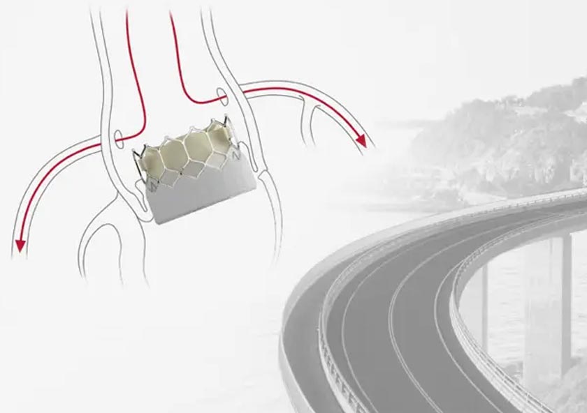 Transcatheter SAPIEN 3 Ultra | Edwards Lifesciences