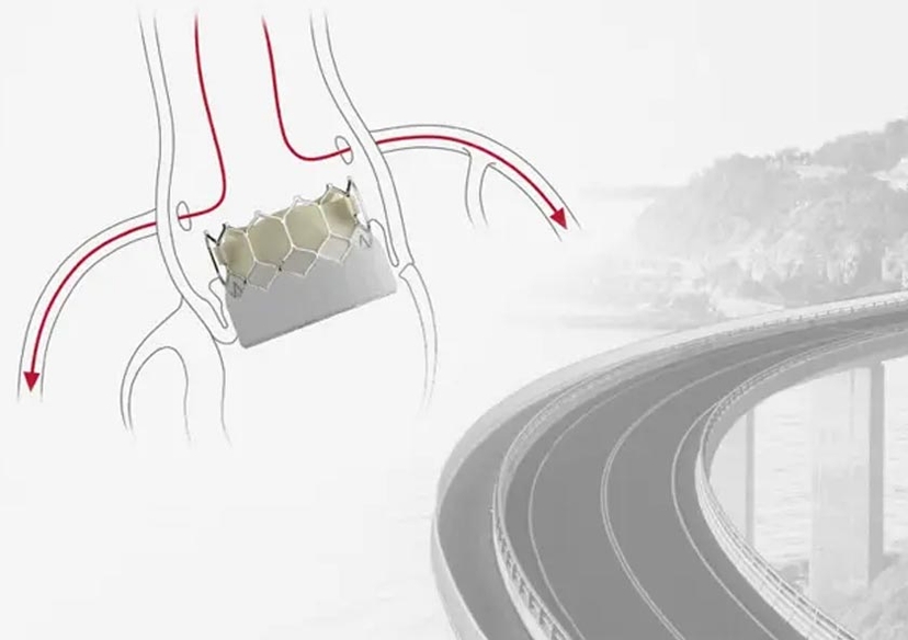 Transcatheter SAPIEN 3 Ultra | Edwards Lifesciences