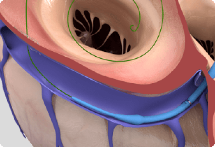 ALT-FLOW trial | Edwards Lifesciences