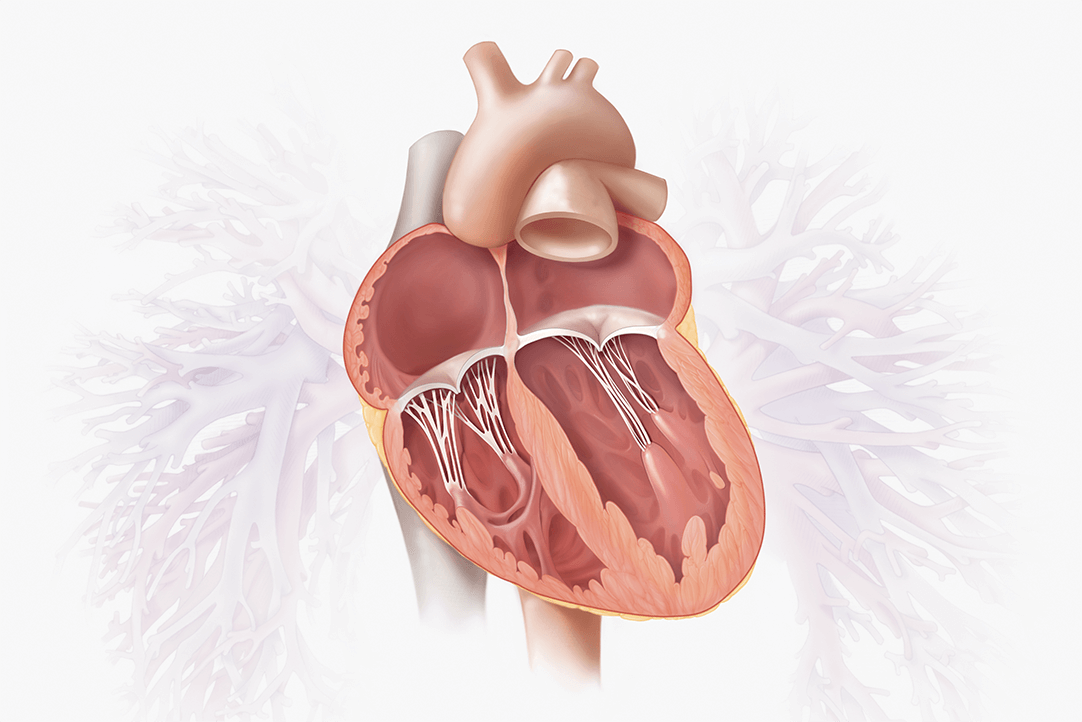 Severe tricuspid valve regurgitation and treatment | Edwards Lifesciences