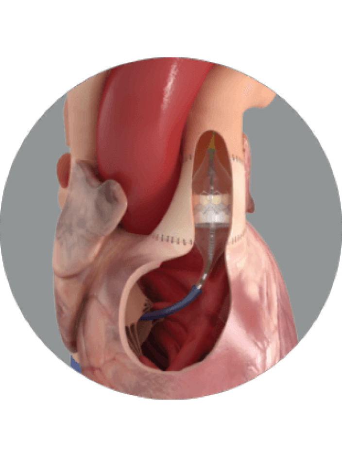 経カテーテル肺動脈弁治療(TPVI) | Edwards Lifesciences