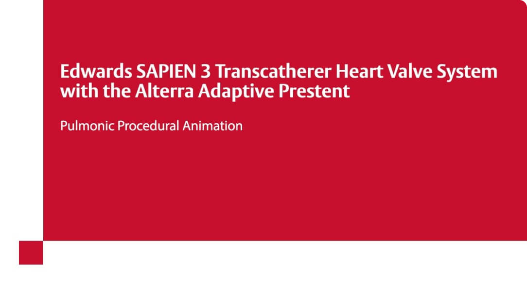 Transcatheter pulmonary valve replacement | Edwards Lifesciences